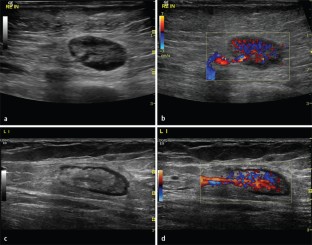 Ultraschall in der Diagnostik maligner Lymphome | SpringerLink