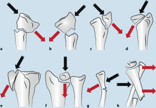 Distale Radiusfrakturen | SpringerLink