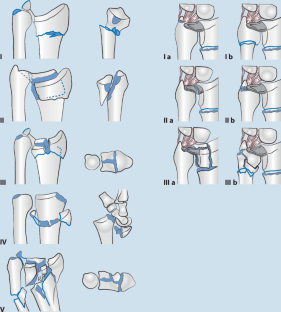 Distale Radiusfrakturen | SpringerLink