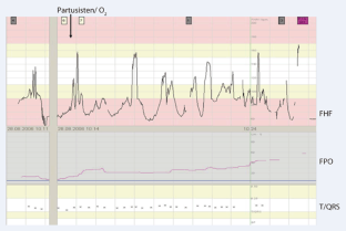 Perspektiven der CTG-Anwendung während der Geburt | SpringerLink