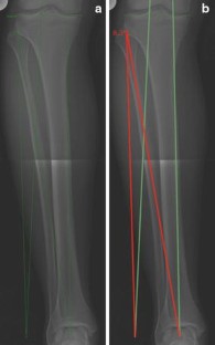 High reliability in digital planning of medial opening wedge high ...