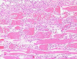 Pyomyositis | SpringerLink