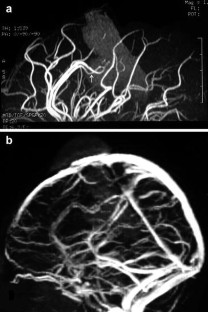 Posterior pericallosal lipoma extending through the interhemispheric ...