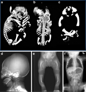 Prenatal diagnosis of fetal skeletal dysplasia with 3D CT | SpringerLink