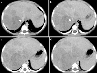 2017 PRETEXT: radiologic staging system for primary hepatic ...