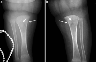 Buckle fracture of the proximal tibia in children and frequency of ...