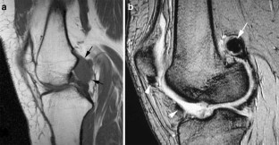 Synovial recesses of the knee: MR imaging review of anatomical and ...