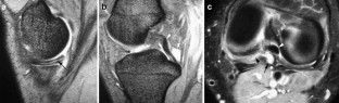 Synovial recesses of the knee: MR imaging review of anatomical and ...