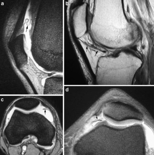 Synovial recesses of the knee: MR imaging review of anatomical and ...
