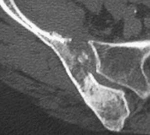 Bony sequestrum: a radiologic review | SpringerLink