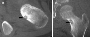 Bony sequestrum: a radiologic review | SpringerLink