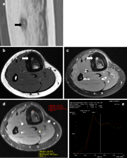 Bony sequestrum: a radiologic review | SpringerLink