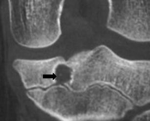 Bony sequestrum: a radiologic review | SpringerLink