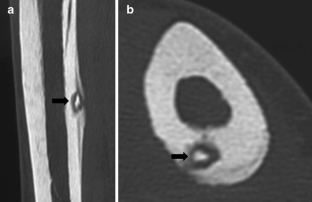 Bony sequestrum: a radiologic review | SpringerLink