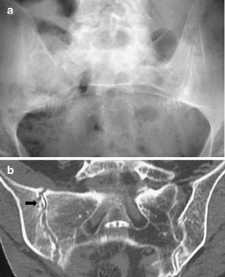 Bony sequestrum: a radiologic review | SpringerLink