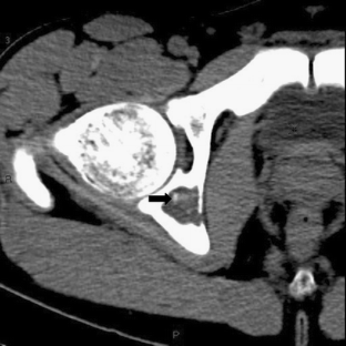 Bony sequestrum: a radiologic review | SpringerLink