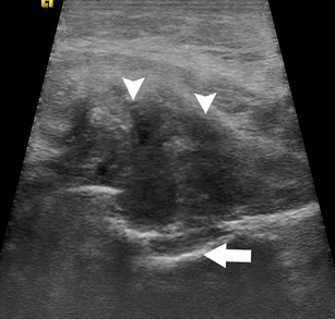 The role of ultrasound in the assessment of post-operative ...