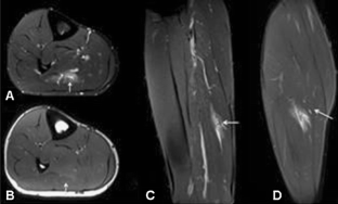 The soleus muscle: MRI, anatomic and histologic findings in cadavers ...