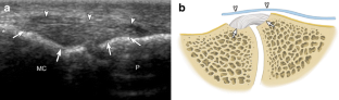 Ultrasound of displaced ulnar collateral ligament tears of the thumb ...