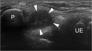 Pisotriquetral joint disorders: an under-recognized cause of ulnar side ...