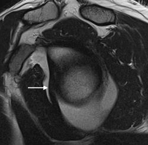 Glenoid avulsion of the glenohumeral ligament (GAGL): a case report and ...
