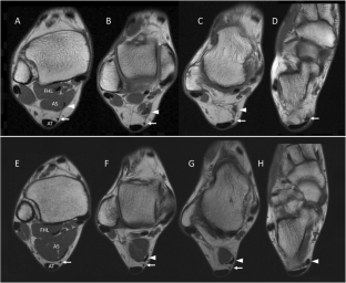 Isolated rupture of the accessory soleus tendon: an original and ...