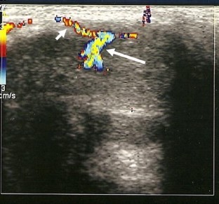 Erectile dysfunction: the role of penile Doppler ultrasound in ...