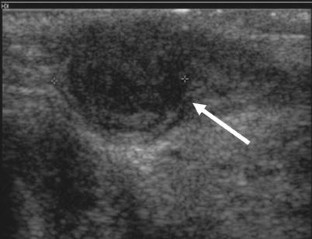 Erectile dysfunction: the role of penile Doppler ultrasound in ...