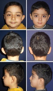 New Otoplasty Approach: A Laterally Based Postauricular Dermal Flap as ...