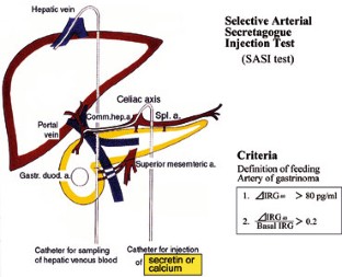 Changing Treatment Strategy for Gastrinoma in Patients with Zollinger ...