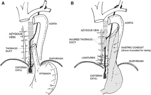 Thoracic Duct Injury Following Esophagectomy in Carcinoma of the ...