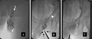 Interventional Radiology of Male Varicocele: Current Status | SpringerLink