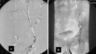Interventional Radiology of Male Varicocele: Current Status | SpringerLink
