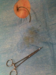Safe Removal of an Encrusted Nephrostomy Tube Using a Vascular Sheath ...