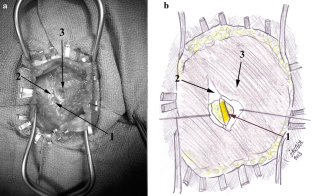 Anatomical basis of transgluteal approach for pudendal neuralgia and ...