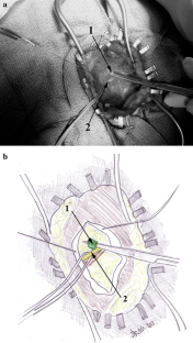 Anatomical basis of transgluteal approach for pudendal neuralgia and ...