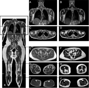 Muscle MRI findings in facioscapulohumeral muscular dystrophy ...