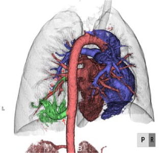 Pulmonary lobectomy techniques in infants and children | SpringerLink