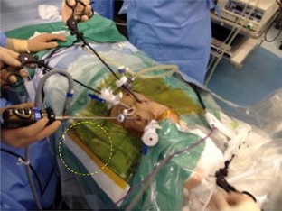 Pulmonary lobectomy techniques in infants and children | SpringerLink