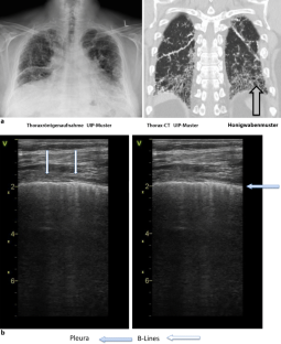 Lungenfibrose bei rheumatischen Erkrankungen | SpringerLink