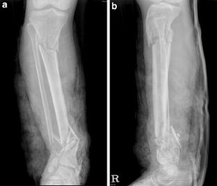 Treatment of an open distal tibia fracture with segmental bone loss in ...