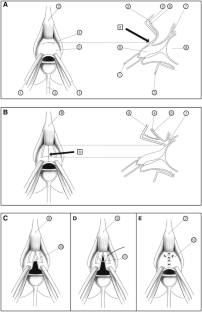 Vaginal cesarean section: heir to, but not legacy of Dührssen’s ...