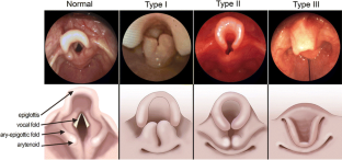 Laser supraglottoplasty for laryngomalacia; a 14 year experience of a ...
