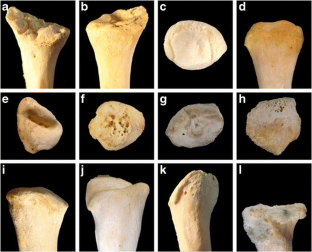 Skeletal age estimation based on medial clavicle—a test of the method ...