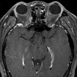 Fourth nerve palsy presenting with trochleodynia | SpringerLink