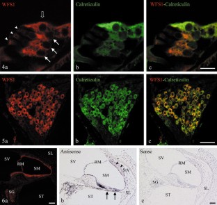 The WFS1 gene, responsible for low frequency sensorineural hearing loss ...