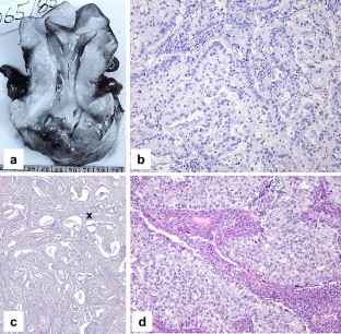 Invasive stratified mucin-producing carcinoma (i-SMILE) of the uterine ...