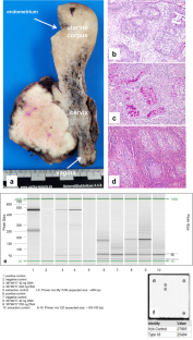 Invasive stratified mucin-producing carcinoma (i-SMILE) of the uterine ...