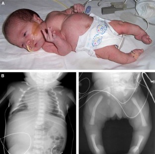 A homozygous nonsense mutation in SOX9 in the dominant disorder campomelic dysplasia: a case of ...