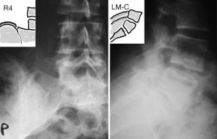 Improved accuracy in Risser sign grading with lateral spinal ...